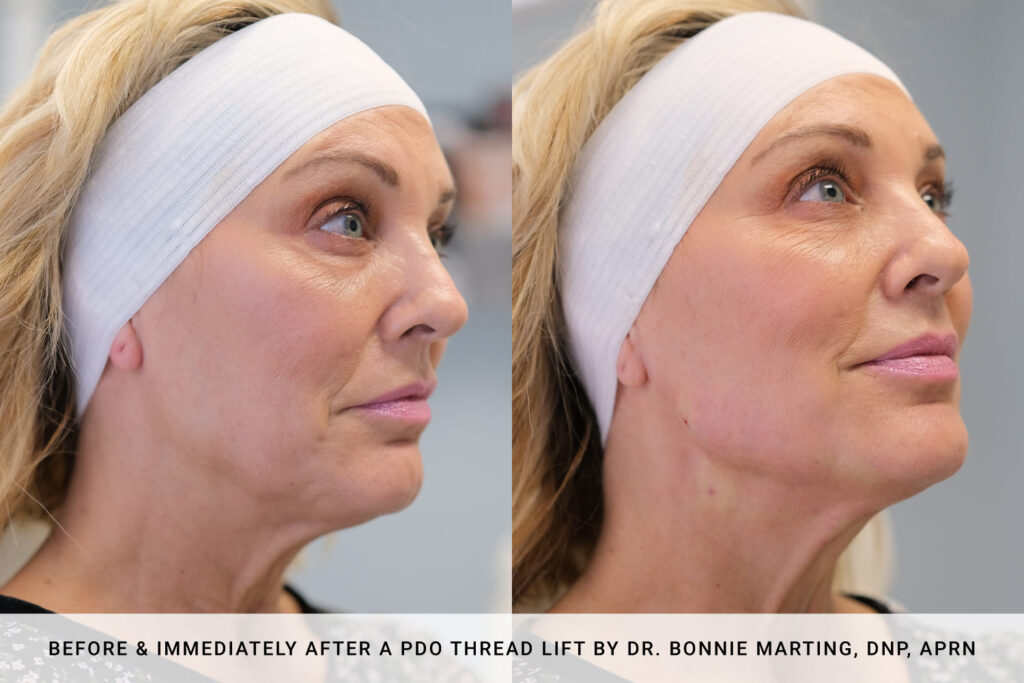 Getting the Most out of a PDO Thread Lift